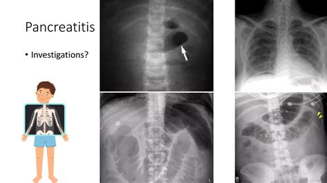 Pancreatitis And Its Complications And Acute Cholangitis Pptx