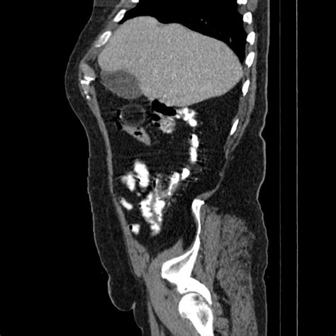 Exophytic Lipomatous Colonic Mass Image