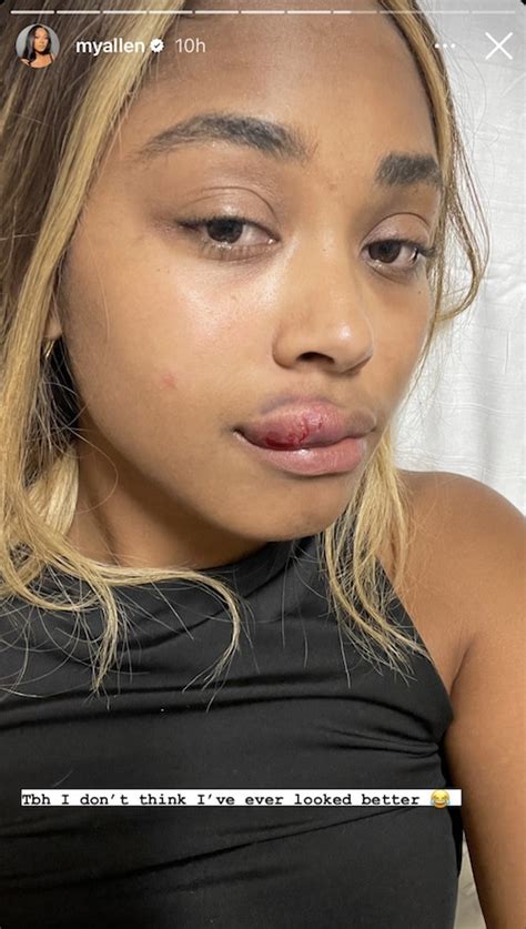 Mya Allen The Pretty Black Girl On Bravos Summer House Gets Bit In