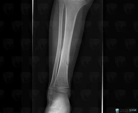 Radiology Case Fracture X Rays Diagnologic