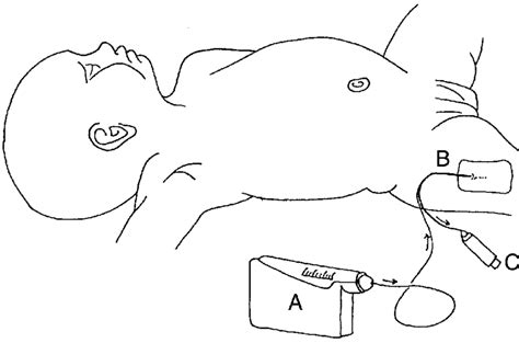 Microdialysis Is A Continuous Sampling Method The Tip Of The Download Scientific Diagram