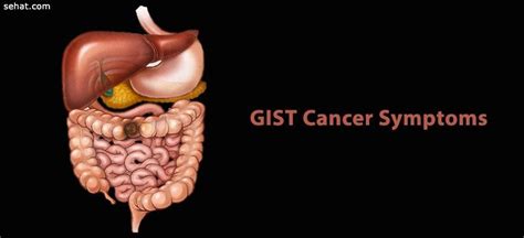 Gist Cancer Symptoms What Is Gist Cancer Sehat