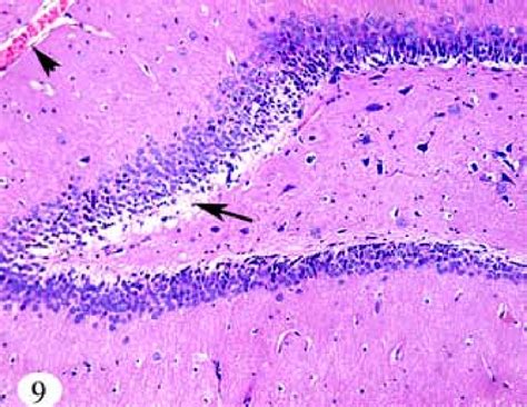 Distortion Of The Granular Cell Layer → Notice Dilated Congested