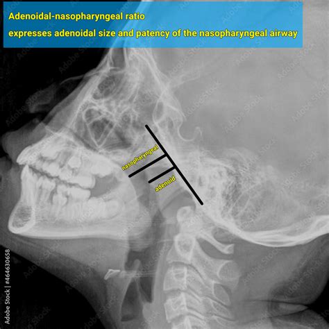 X Ray Of Adenoid Nasopharyngeal Ratio Stock Vector Adobe Stock