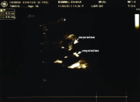 Transthoracic Echocardiography Plax View Showing Vegetation Attached Download Scientific