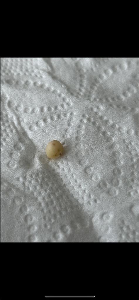 3 4mm Chickpea Looking Pebble In Stool Picture R Candida