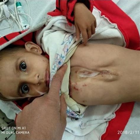 Epithelialisation Over Sternal Defect Download Scientific Diagram