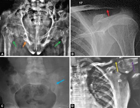 Primary Hyperparathyroidism Radiology