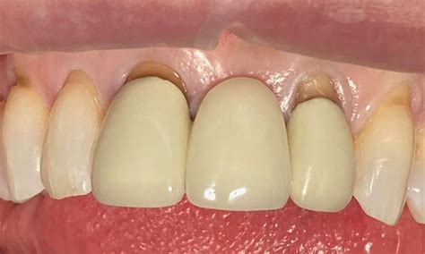 Porcelain Bridge To Replace A Missing Front Tooth Before And After Photos