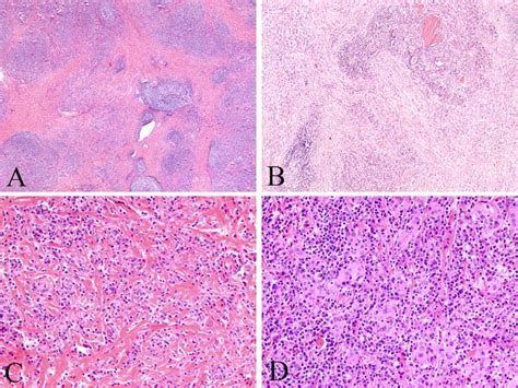 Fibrosing Variant Of Hashimoto Thyroiditis Is An Igg4 Related Disease