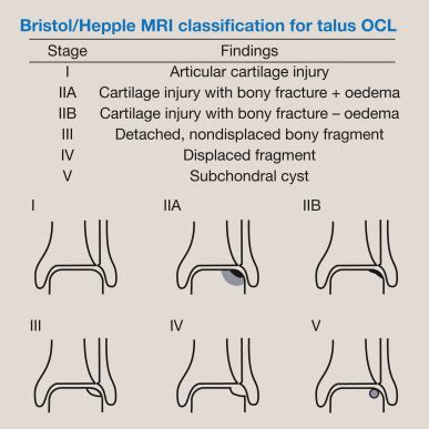 Osteochondral Lesions Of The Talus Foot Ankle