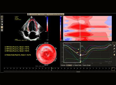 Its High Time For Epiq Philips Healthcare