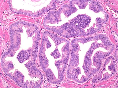 High Grade Prostatic Intraepithelial Neoplasia High Grade … Flickr