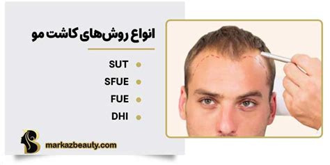 کاشت مو اصفهان بهترین مراکز قیمت 1404 مرکز بیوتی