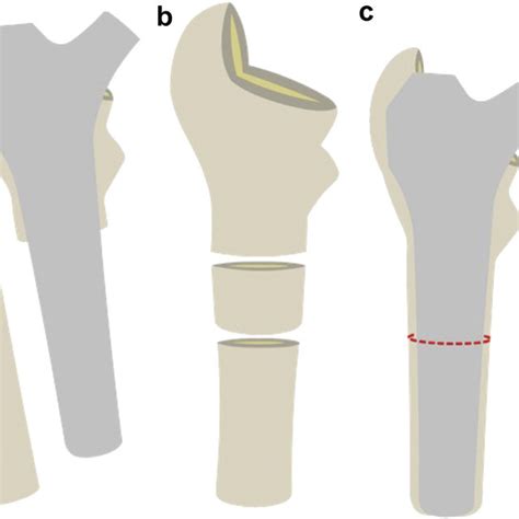 Preoperative Leg Length Discrepancy On Pelvic Radiography With A