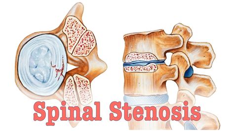 Spinal Stenosis