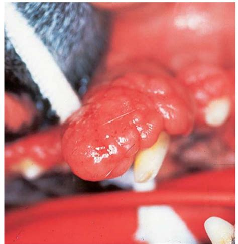 4 Gingival Hyperplasia The Hyperplastic Gingival Tissue