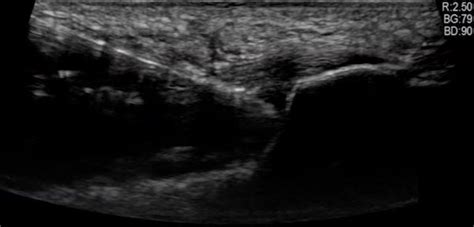 Plantar Fasciitis Injection A Closer Look Sport Doctor London