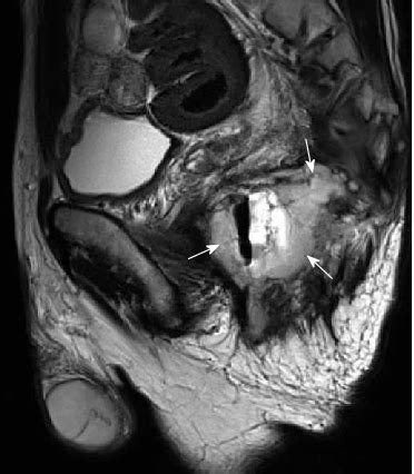 Mucinous Adenocarcinoma Of Rectum Sagittal T2 Weighted Mri Image