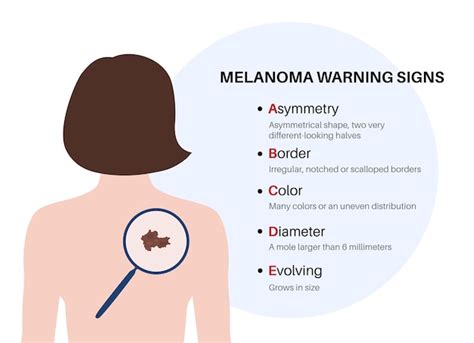 Premium Vector Melanoma Warning Signs