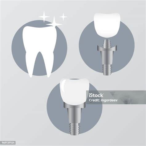 치과 의료 및 구강 위생 벡터입니다 구강 보 철물 이식 평면 벡터 일러스트 레이 션 건강관리와 의술에 대한 스톡 벡터 아트 및 기타 이미지 건강관리와 의술 금속