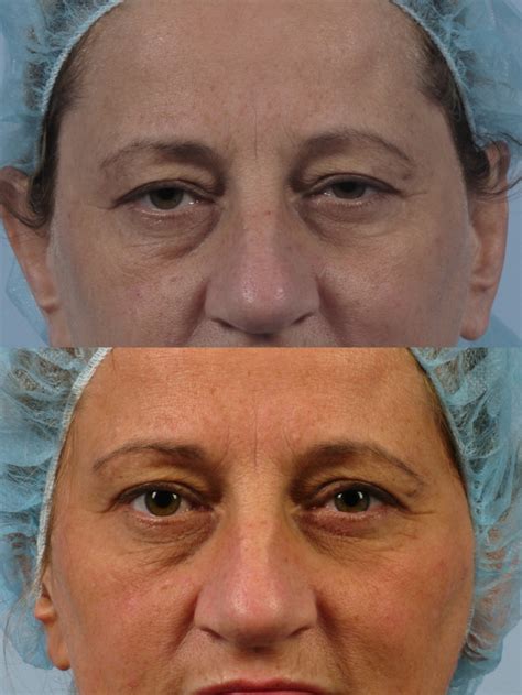Eyelid Ptosis Surgery Dr Brett Kotlus