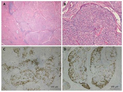 Cholangiocarcinoma Histology
