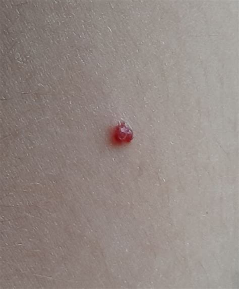 Червена бенка или нещо друго Здравословни проблеми Мнения от Bg Mamma