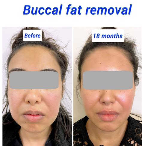 Buccal Fat Removal Jakarta At Janie Clark Blog