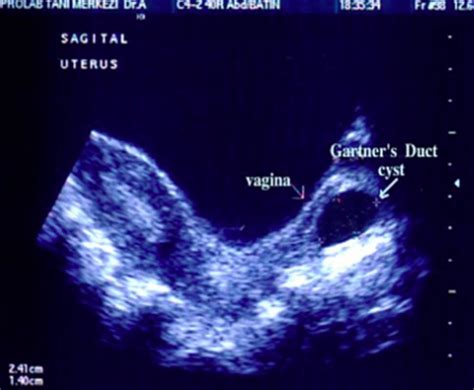 Gartners Duct Cyst Ultrasound
