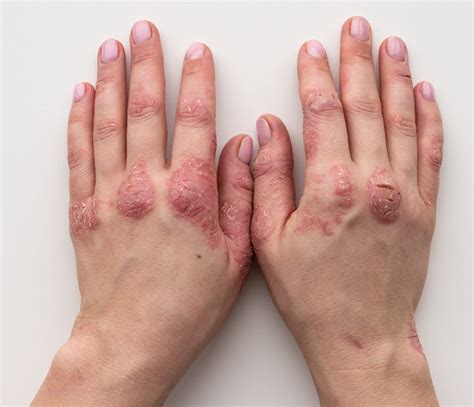 Totul Despre Psoriazis Cauze Simptome și Prevenire Medstore
