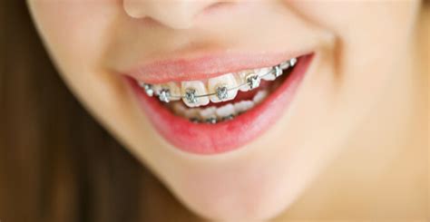 Do You Have A Malocclusion Braces Can Help Central Texas Orthodontics