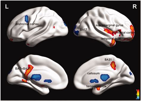 Global Functional Connectivity Density Alterations In Healthy