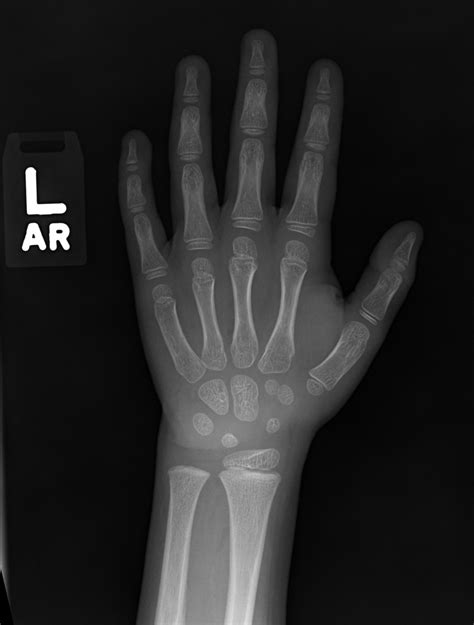 Bone Classification Dataset And Pre Trained Model By Bones