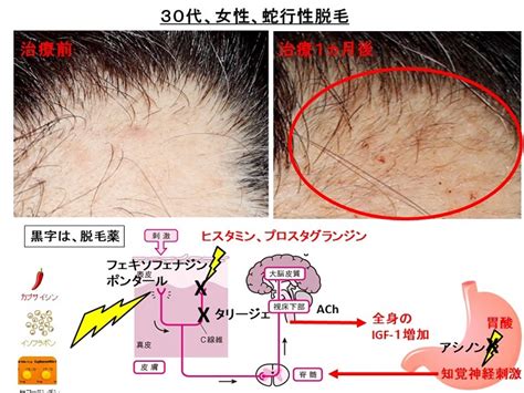 薬害脱毛の患者さん生え替わりの抜け毛不安も産毛が増えて安心 患者様からの声メディア掲載クリニックからのお知らせ 名古屋Kクリニック
