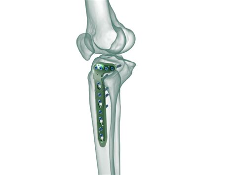 True Lock Proximal Tibia Lateral Anatomic Plate Truemed Medikal