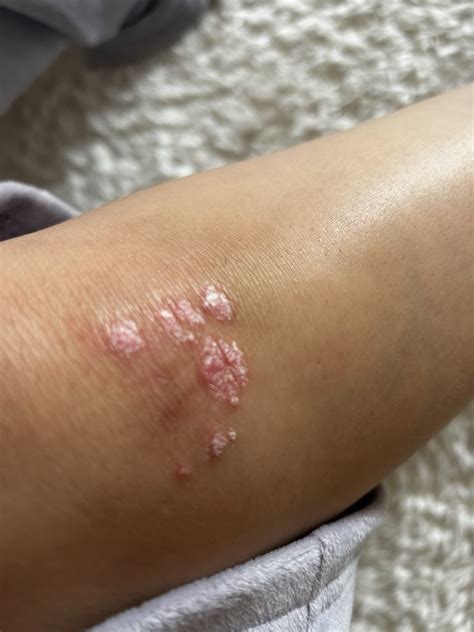 Арьс харшлын мэргэжлийн эмчийн зөвлөгөө Өвдөгөн дээр гарсан энэ талаар мэдэх хүн байна уу