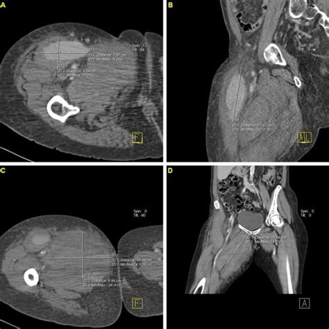 Multislice Computed Tomography Images Demonstrating The Pseudoaneurysms
