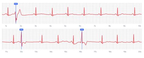 What Premature Ventricular Contraction Pvc Looks Like On Your Watch