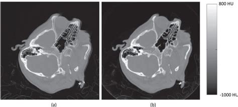 Motion Correction Applied To The Helical Ct Scan Of A Patient With
