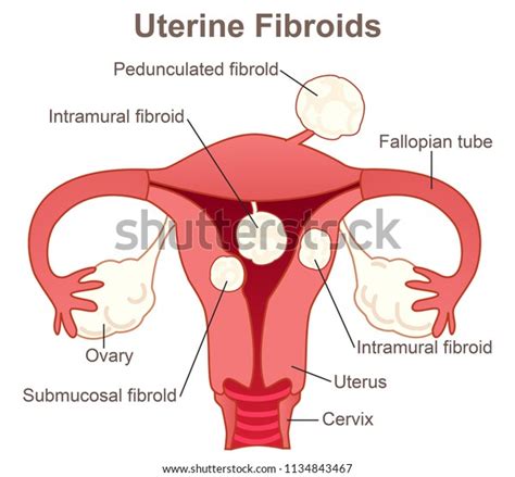 Intramural Fibroid Ultrasound