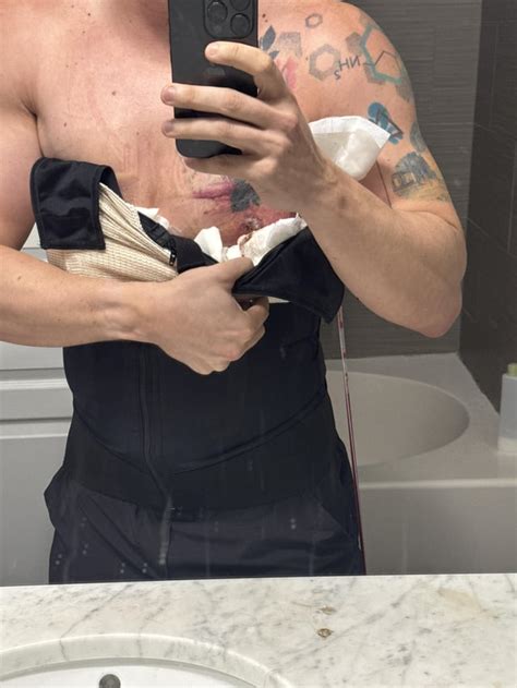 Hematoma Post Surgery Rgynecomastia