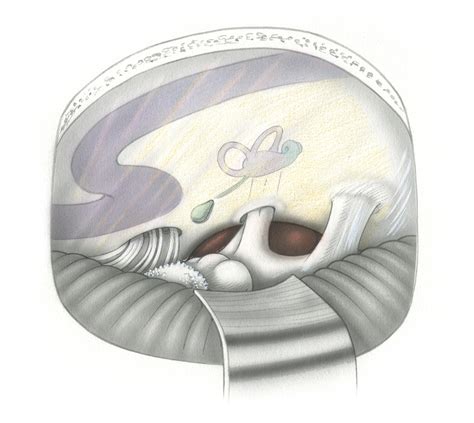 Transcochlear Approach Skull Base Surgery Atlas