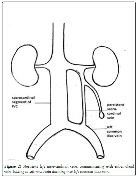 Retro Aortic Left Renal Vein Draining Into Left Common Iliac Vein A Rare Renal Vein Anomaly And