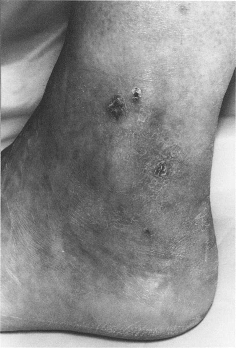 Complete Healing Of The Pyoderma Gangrenosum Eight Weeks After The Download Scientific Diagram