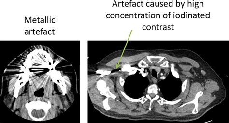 Beam Hardening Artefacts Cbct The Best Picture Of Beam