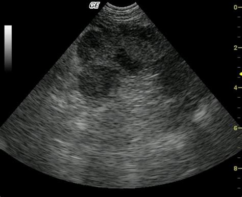 Fibrosarcoma Of The Spleen And Liver Diagnosed By Tru Cut Biopsy In A 10 Year Old Mn Pug Members