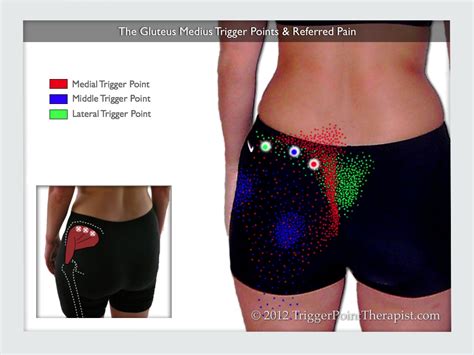 The Gluteus Medius Trigger Points And Low Back Pain