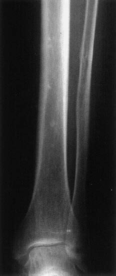Standard X Ray Of The Left Tibia Performed 3 Years After Local