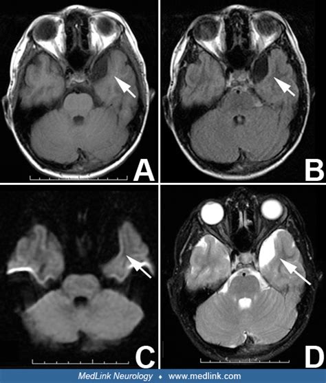 Arachnoid Cyst Medlink Neurology